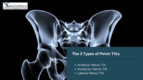 Align Your Life: Chiropractic Aid for Pelvic Tilt